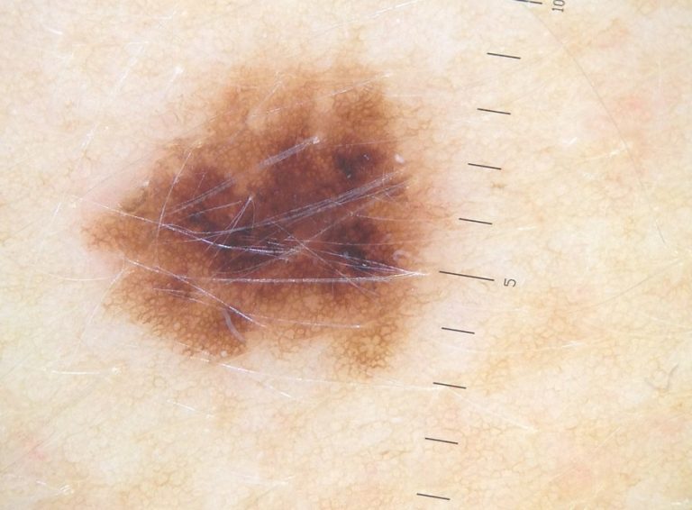 Znamiona barwnikowe - jak je rozpoznać? | Gabinet Dermatologiczny J ...