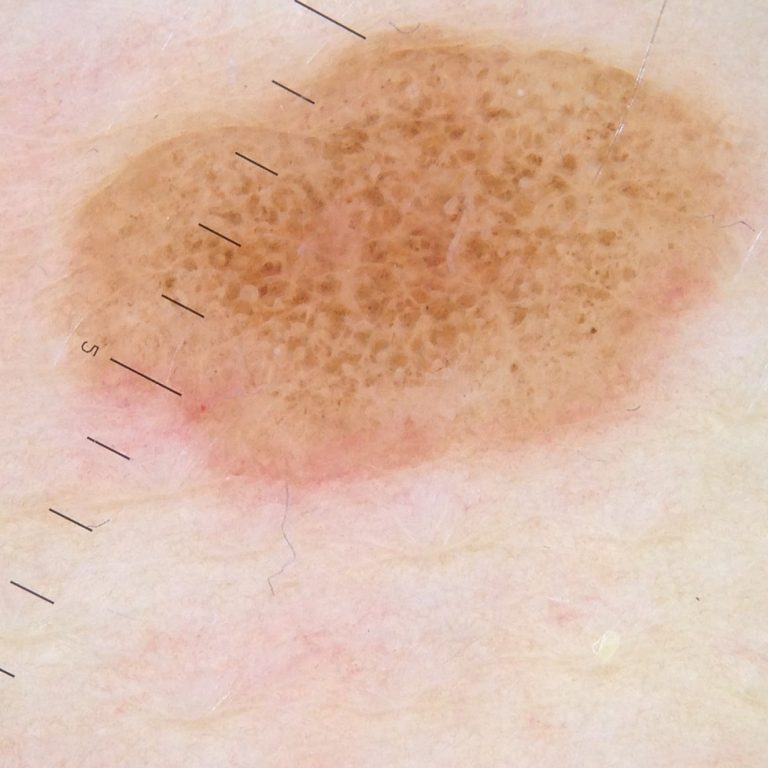 Znamiona barwnikowe - jak je rozpoznać? | Gabinet Dermatologiczny J ...